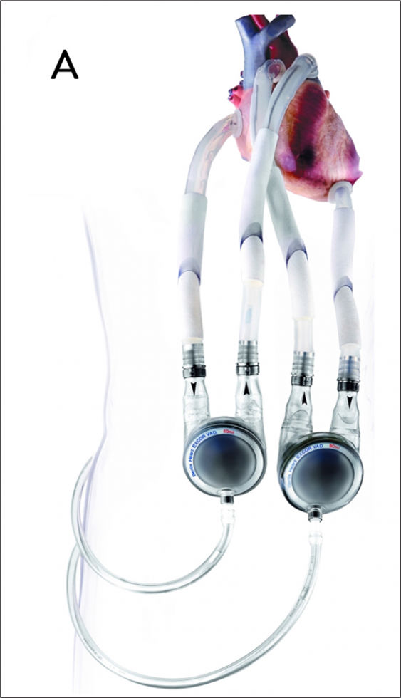 Herztransplantation und mechanische Kreislaufunterstützung – der ...