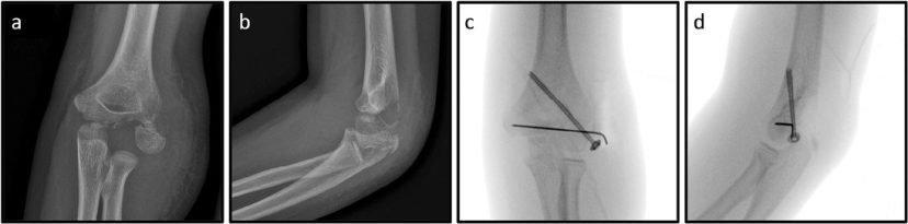 Besonderheiten bei Gelenkfrakturen im Kindesalter - BDC|Online