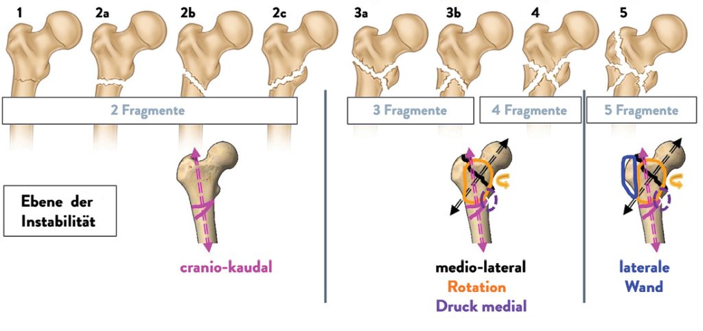 CME-Artikel: Subtrochantäre Femurfrakturen: eine operative Herausforderung? - BDC|Online