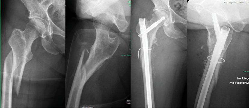 CME-Artikel: Subtrochantäre Femurfrakturen: eine operative ...