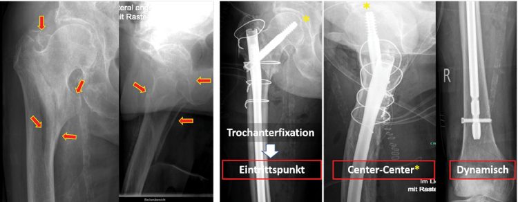 CME-Artikel: Subtrochantäre Femurfrakturen: eine operative ...