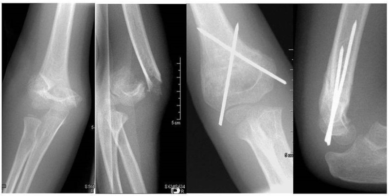 Traumatologie im Kindesalter: OP-Indikation bei häufigen Frakturen - BDC|Online