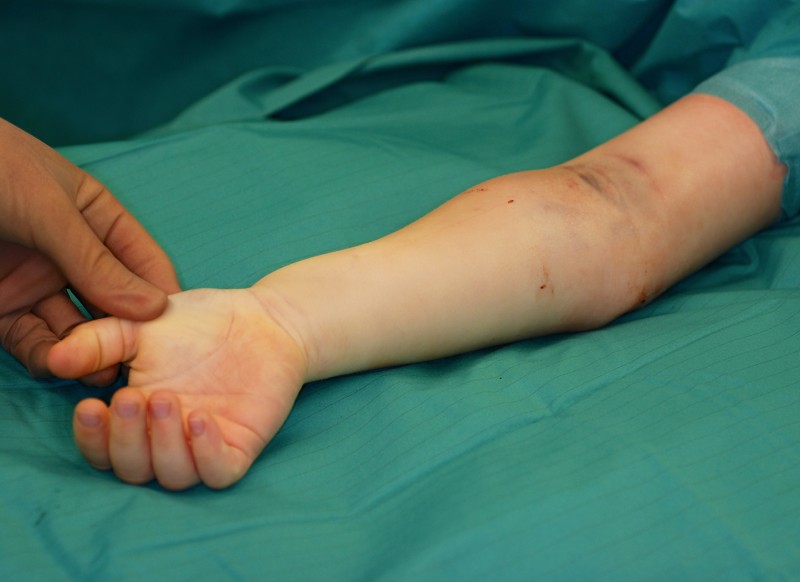 Traumatologie im Kindesalter: OP-Indikation bei häufigen Frakturen ...