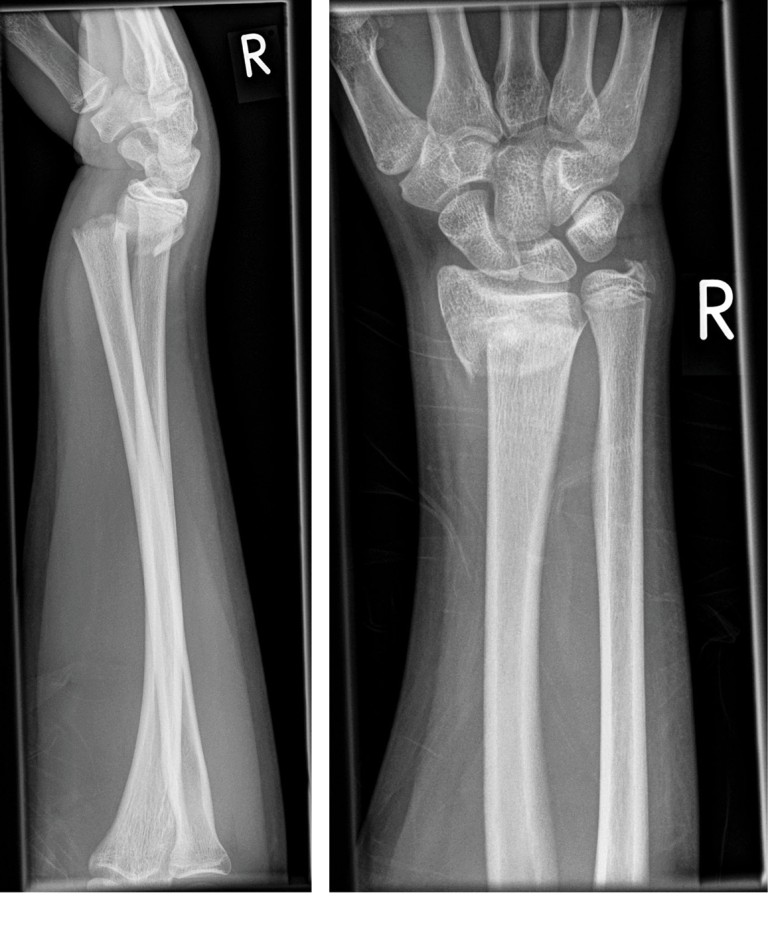 Traumatologie im Kindesalter: OP-Indikation bei häufigen Frakturen - BDC|Online