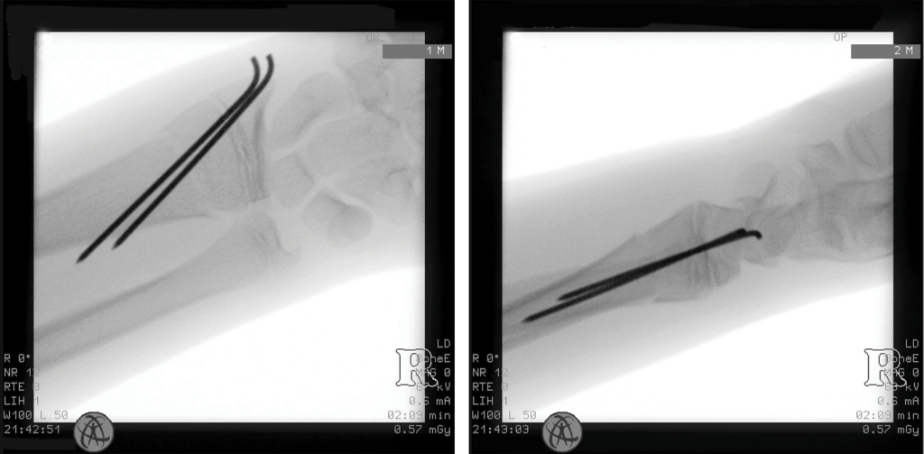 Traumatologie im Kindesalter: OP-Indikation bei häufigen Frakturen ...