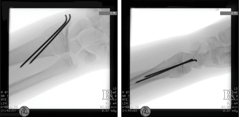 Traumatologie im Kindesalter: OP-Indikation bei häufigen Frakturen - BDC|Online