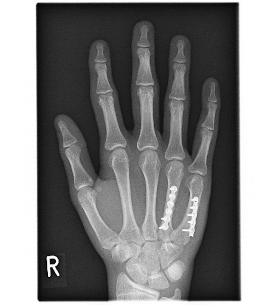 Osteosynthesen in der chirurgischen Praxis - BDC|Online