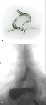 CME-Artikel: Der Thoraxmagen - BDC|Online