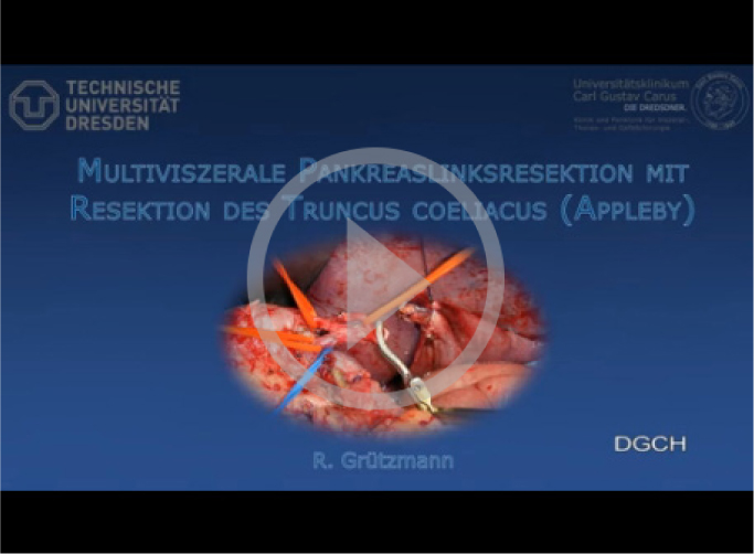 Schau Dich schlau: Appleby Operation bei ausgedehntem Pankreaskorpus ...