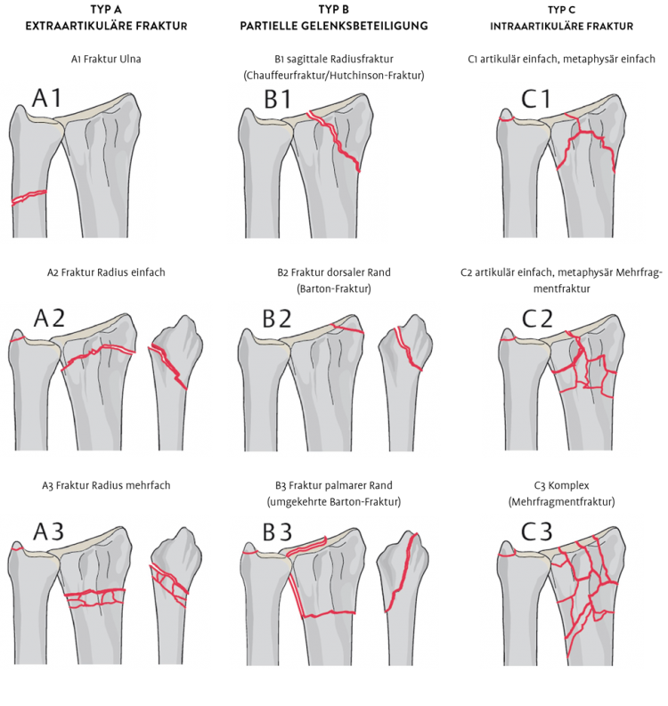 Die Radiusfraktur - BDC|Online