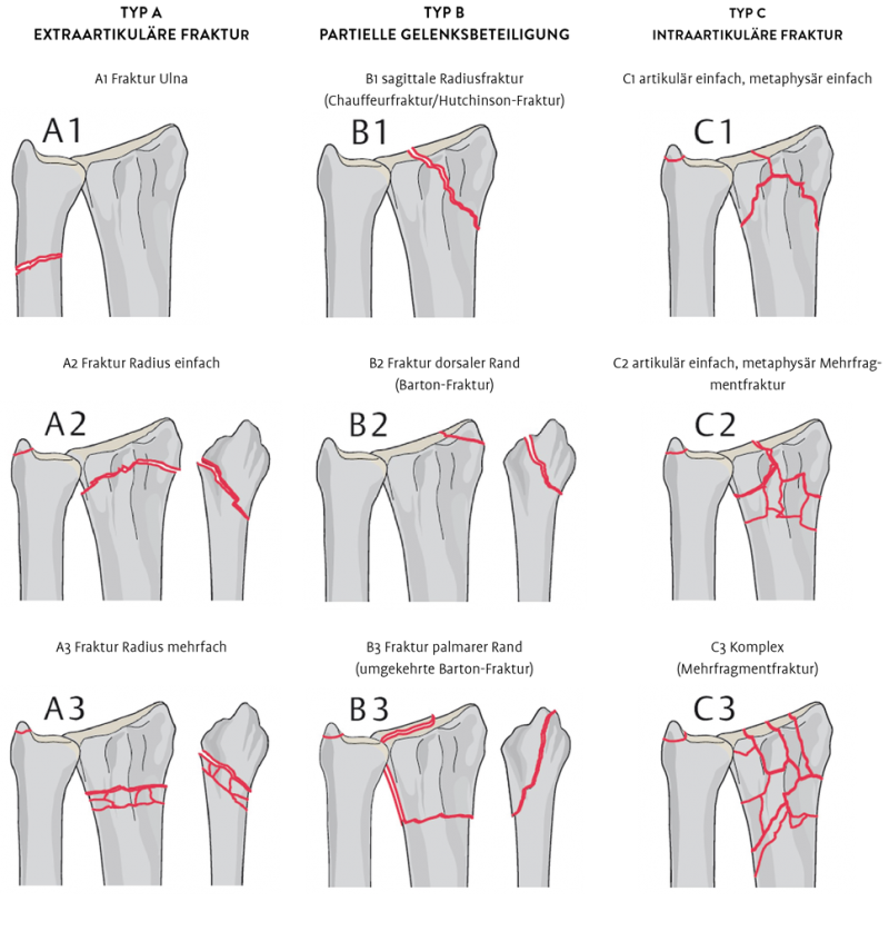 Die Radiusfraktur - BDC|Online