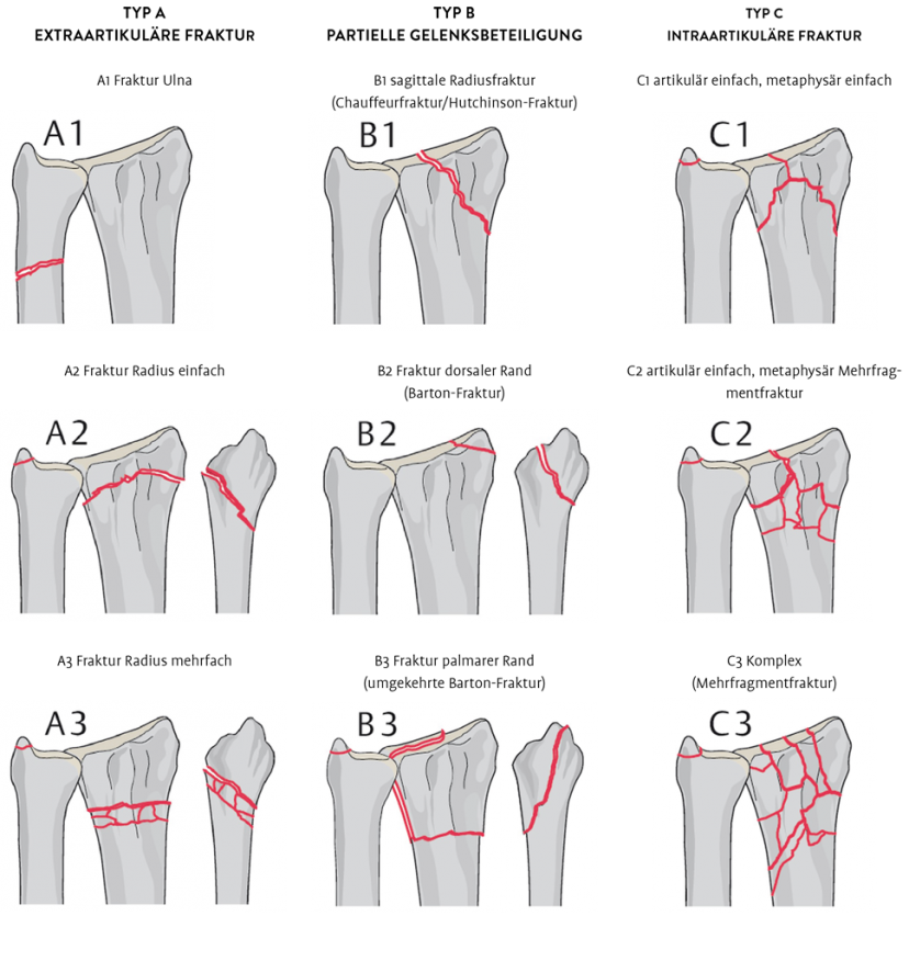 Die Radiusfraktur - BDC|Online