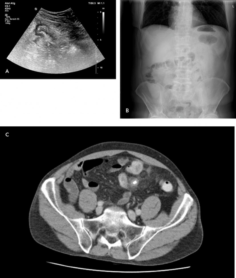 Akute Appendizitis bei intestinaler Malrotation - BDC|Online