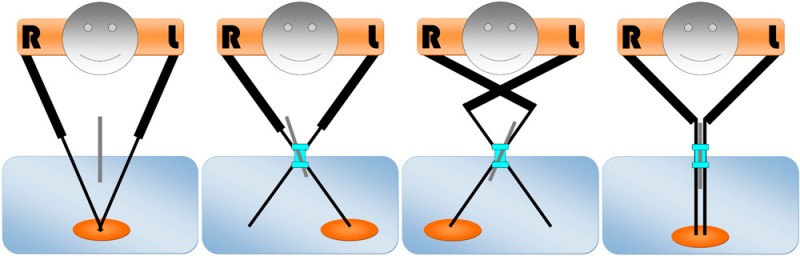 Single Port Endokopische Chirurgie – aktueller Stand - BDC|Online