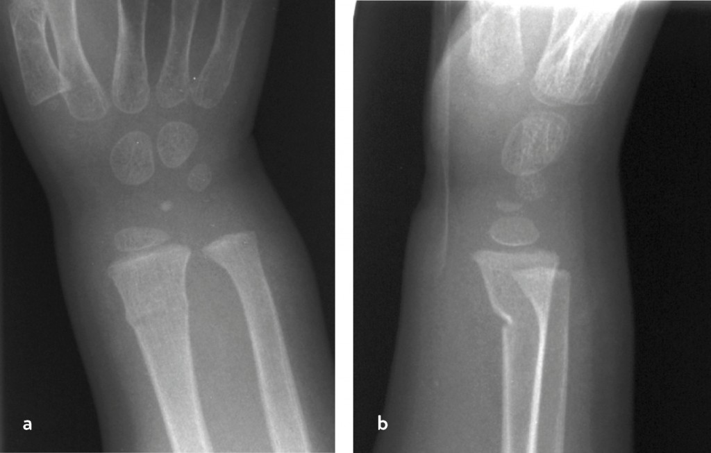 CME-Artikel: Distale Radiusfrakturen im Kindesalter – Sinn und Unsinn ...
