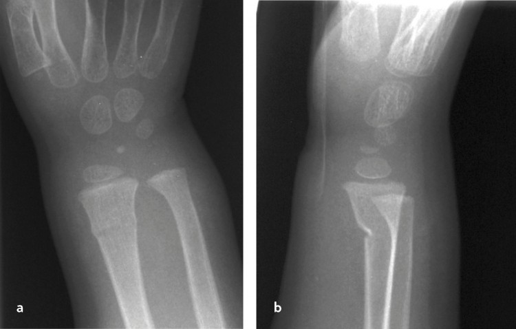 CME-Artikel: Distale Radiusfrakturen im Kindesalter – Sinn und Unsinn ...