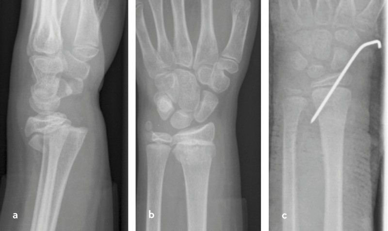 CME-Artikel: Distale Radiusfrakturen im Kindesalter – Sinn und Unsinn ...