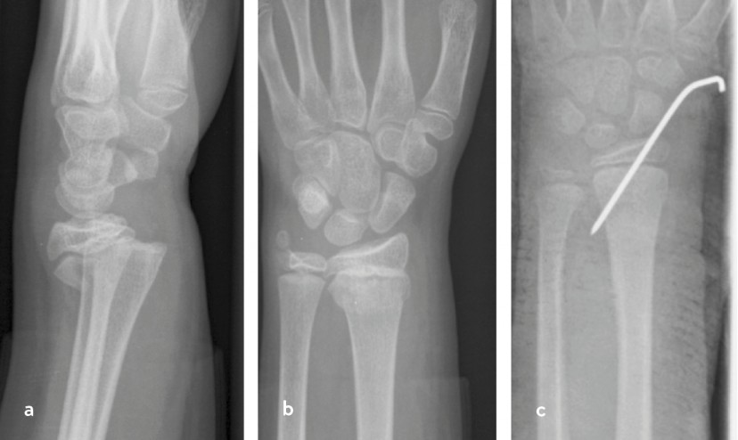 CME-Artikel: Distale Radiusfrakturen im Kindesalter – Sinn und Unsinn ...