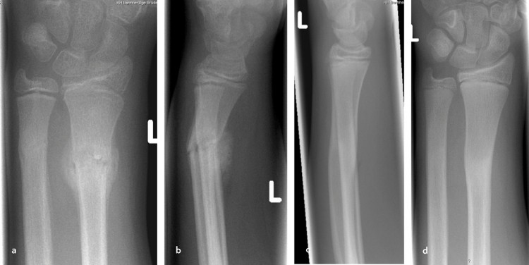 CME-Artikel: Distale Radiusfrakturen im Kindesalter – Sinn und Unsinn ...