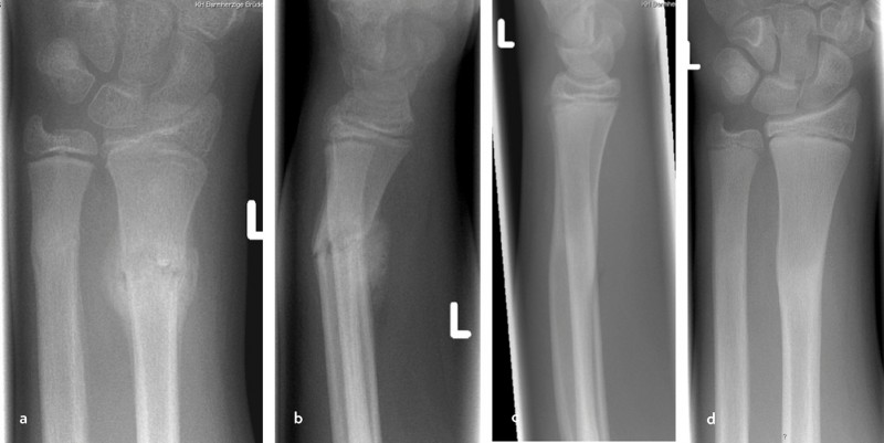 CME-Artikel: Distale Radiusfrakturen im Kindesalter – Sinn und Unsinn ...