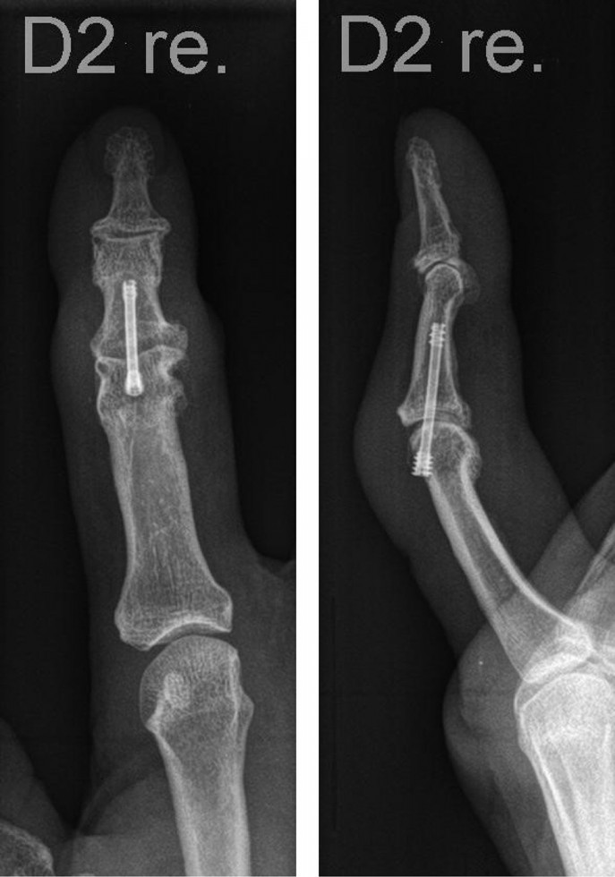 Arthrodesen in der Hand – Neue Therapieverfahren - BDC|Online